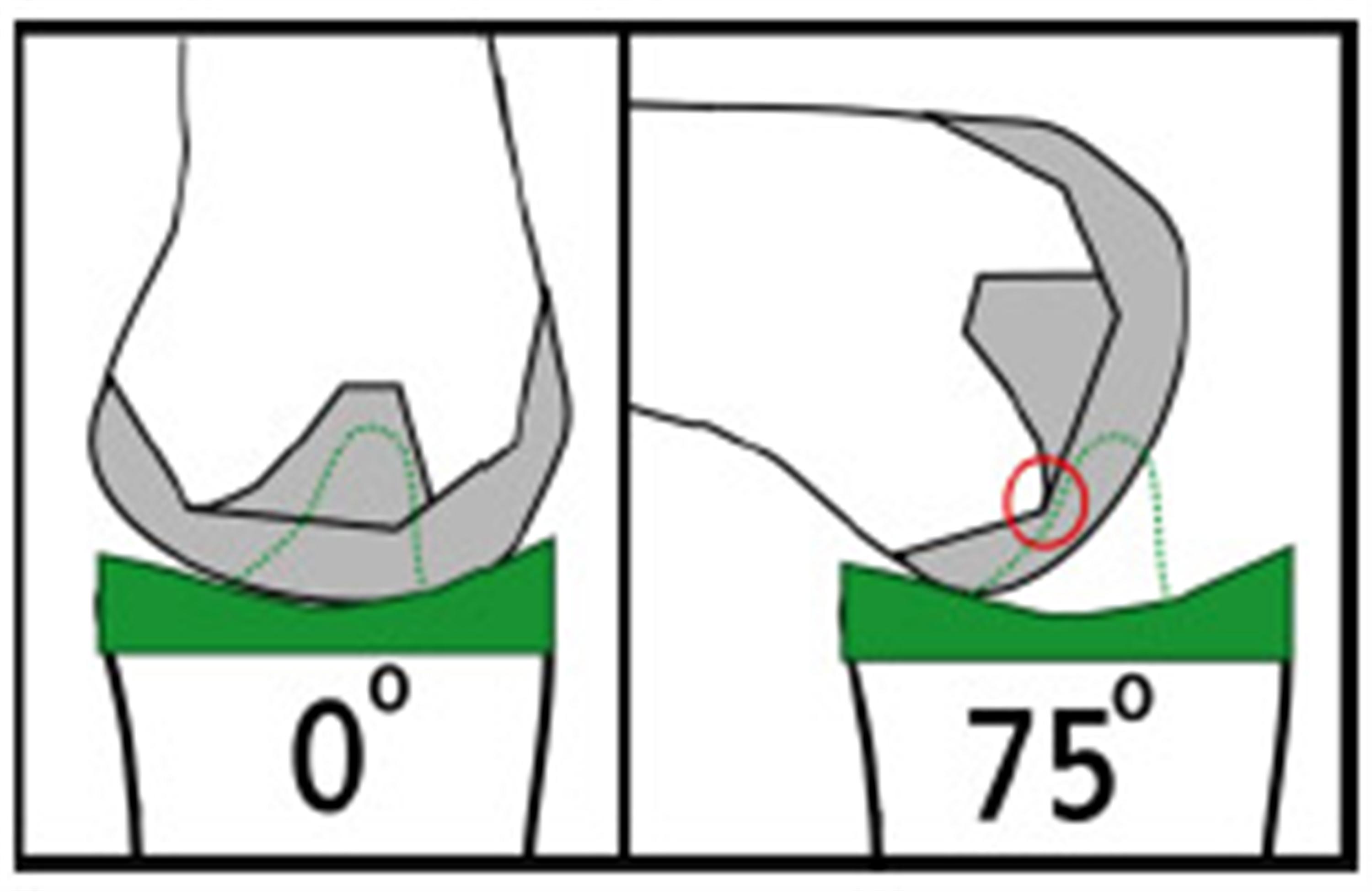 TKA Prosthesis Design - Recon - Orthobullets