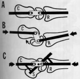 Wrist Ligaments & Biomechanics - Hand - Orthobullets