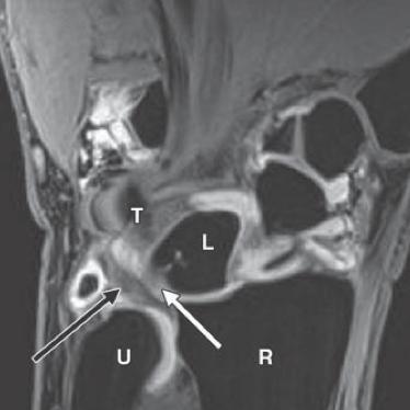 Wrist Ligaments & Biomechanics - Hand - Orthobullets