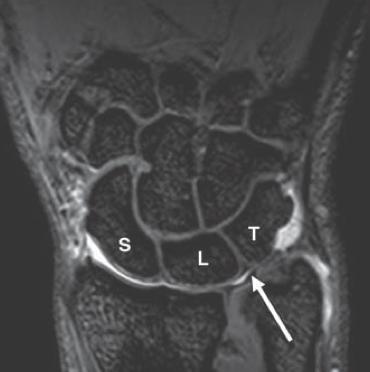 Wrist Ligaments & Biomechanics - Hand - Orthobullets