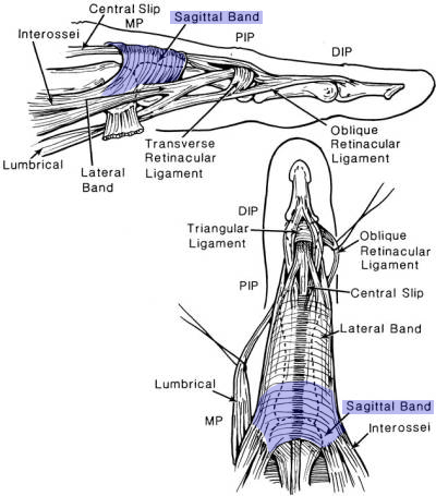 Sagittal Band Rupture - Hand - Orthobullets