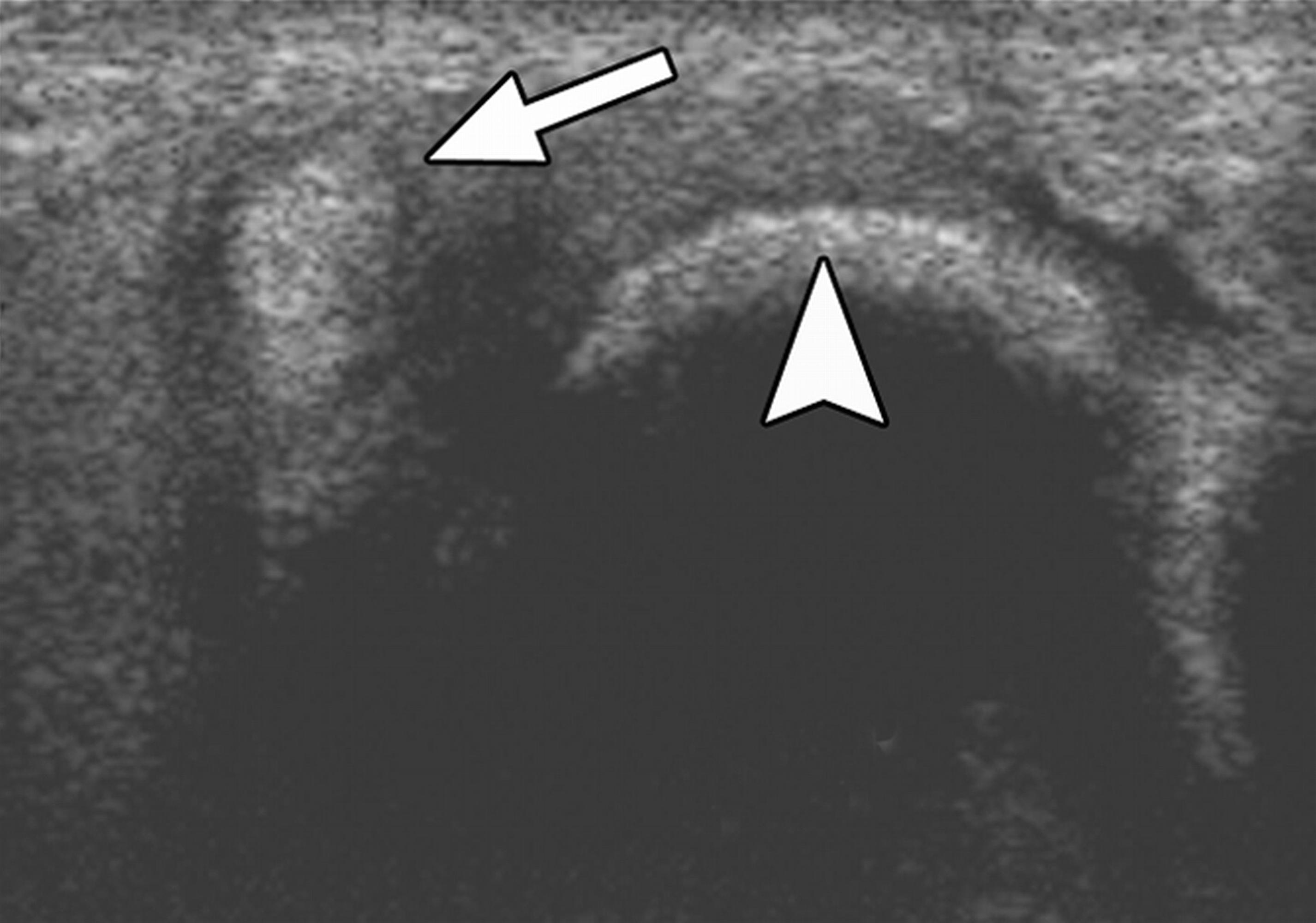 Sagittal Band Rupture - Hand - Orthobullets