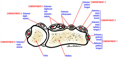 Intersection Syndrome - Hand - Orthobullets