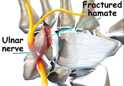 Hook Of Hamate Fracture Hand Orthobullets Hook Of Hamate Fracture Hand Orthobullets