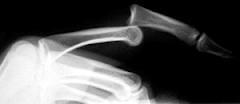 Phalanx Dislocations - Hand - Orthobullets
