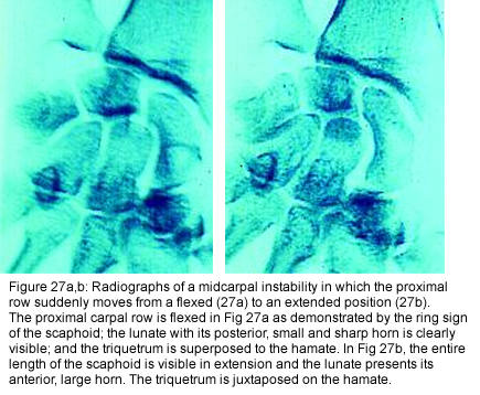 Carpal Instability Nondissociative (CIND) - Hand - Orthobullets