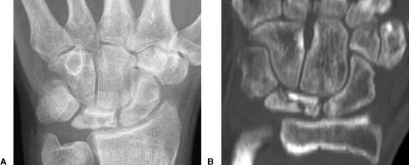 Kienbock's Disease - Hand - Orthobullets