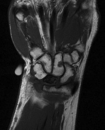 Kienbock's Disease - Hand - Orthobullets