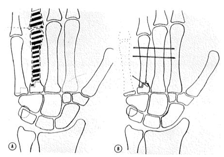 Extremity Flap Reconstruction - Hand - Orthobullets