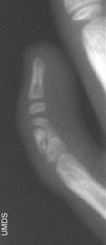 Clinodactyly - Hand - Orthobullets