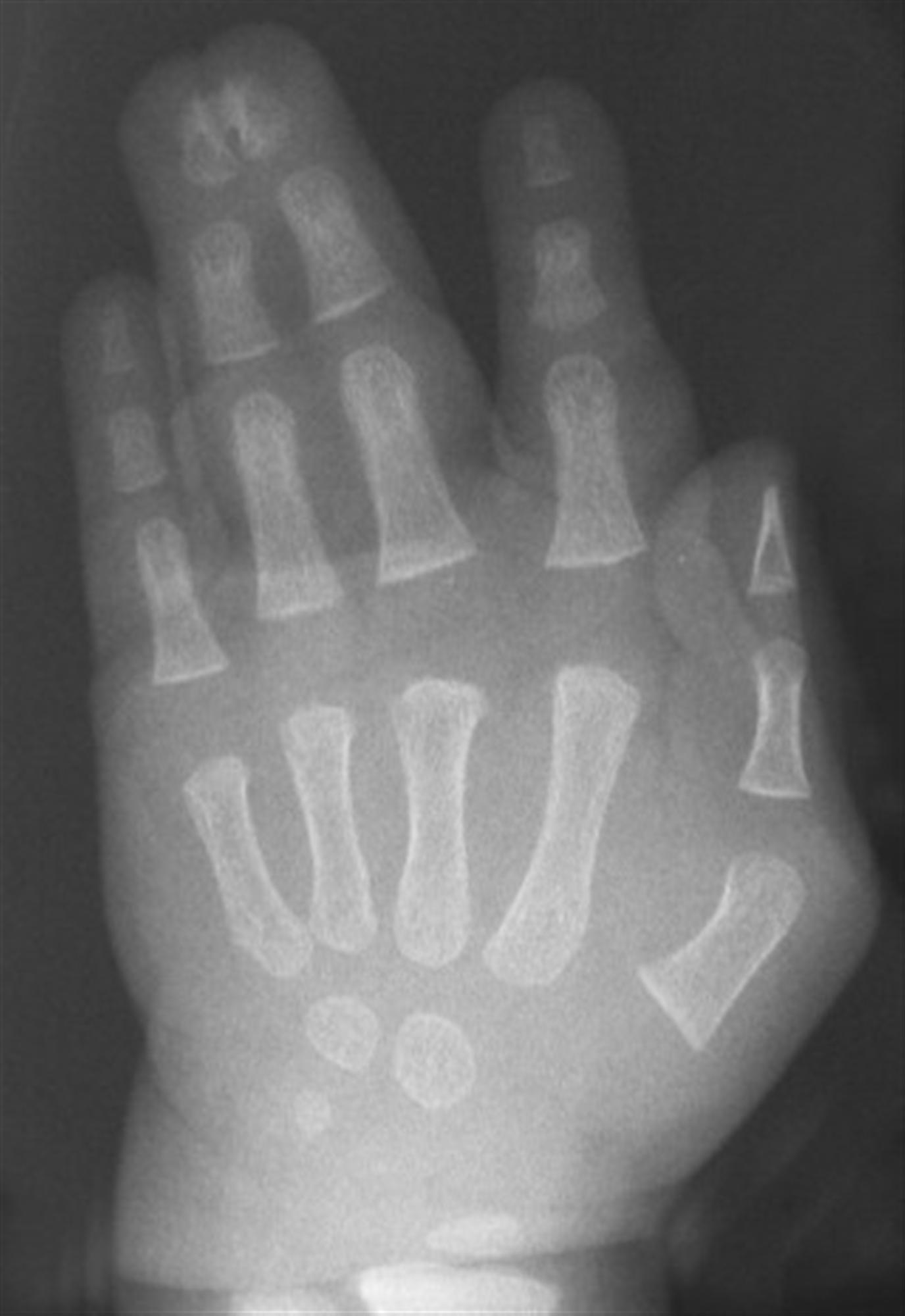Syndactyly - Hand - Orthobullets
