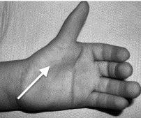Thumb Hypoplasia - Hand - Orthobullets