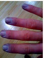 Raynaud's Syndrome - Hand - Orthobullets