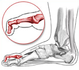 Claw Toe - Foot & Ankle - Orthobullets