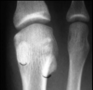 Mallet Toe - Foot & Ankle - Orthobullets