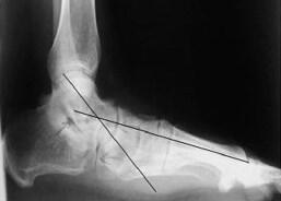 Posterior Tibial Tendon Insufficiency (PTTI) - Foot & Ankle - Orthobullets