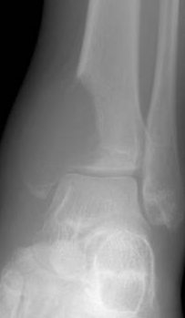 Osteoid Osteoma - Pathology - Orthobullets