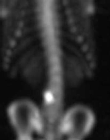 Osteoid Osteoma - Pathology - Orthobullets