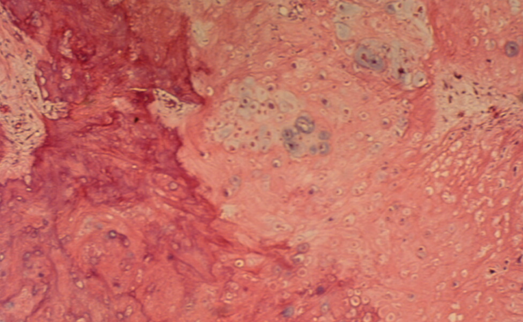 Conventional Intramedullary Osteosarcoma - Pathology - Orthobullets