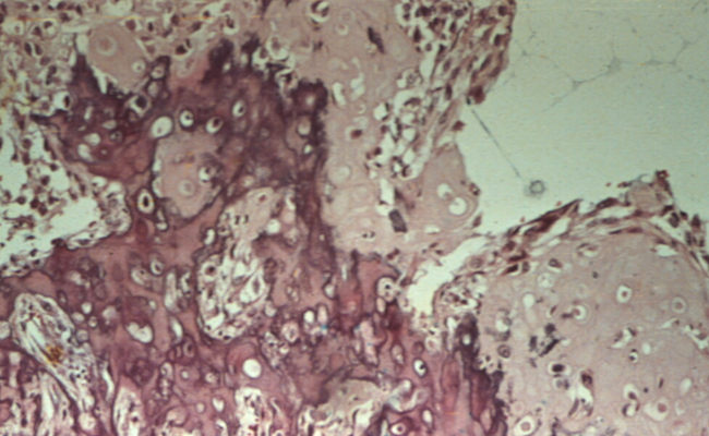 Conventional Intramedullary Osteosarcoma - Pathology - Orthobullets