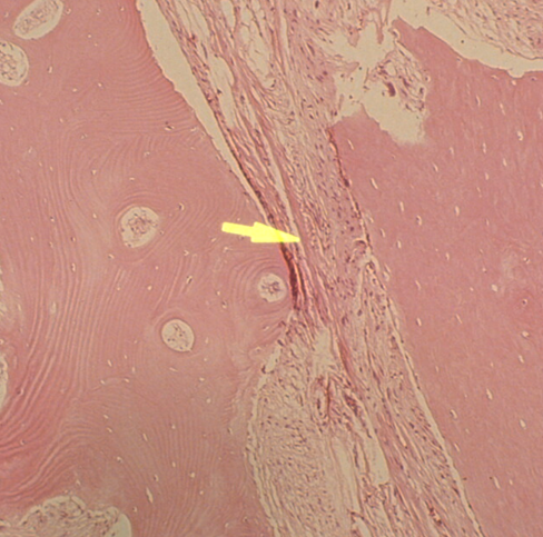 Parosteal Osteosarcoma - Pathology - Orthobullets