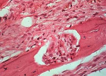 Parosteal Osteosarcoma - Pathology - Orthobullets