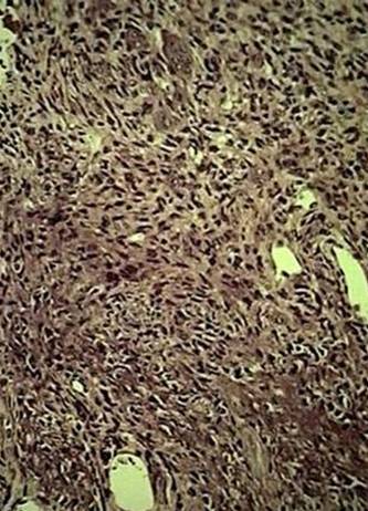 Periosteal Osteosarcoma - Pathology - Orthobullets