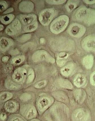 Periosteal Osteosarcoma - Pathology - Orthobullets