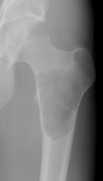 Enchondromas - Pathology - Orthobullets