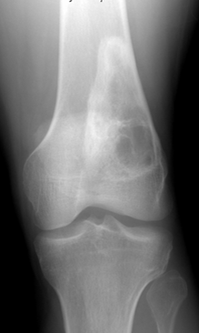 Enchondromas - Pathology - Orthobullets
