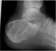 Enchondromas - Pathology - Orthobullets