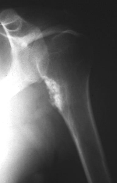Periosteal Chondromas - Pathology - Orthobullets