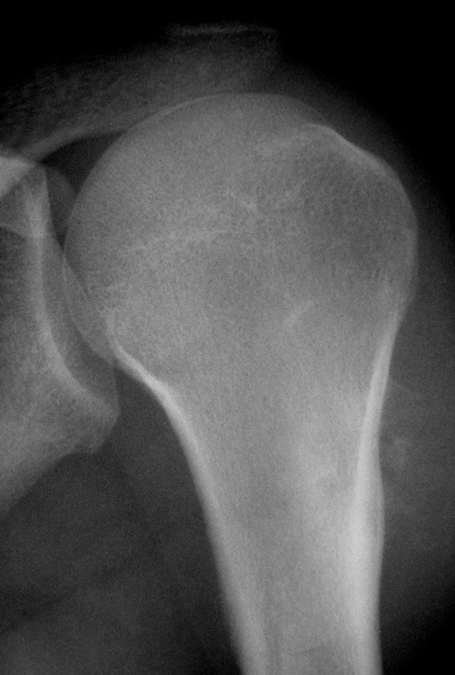 Periosteal Chondromas - Pathology - Orthobullets