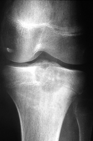 Chondroblastoma - Pathology - Orthobullets