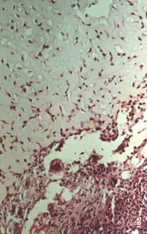 Chondromyxoid Fibroma - Pathology - Orthobullets