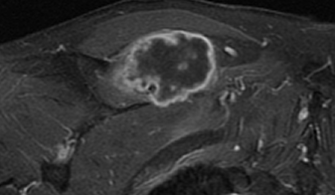 Chondrosarcoma - Pathology - Orthobullets
