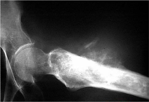 Chondrosarcoma - Pathology - Orthobullets