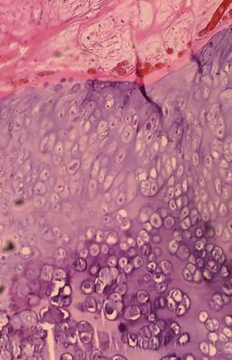 Chondrosarcoma - Pathology - Orthobullets
