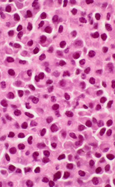 Multiple Myeloma - Pathology - Orthobullets