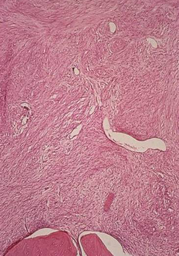 Histiocytoma (Benign Fibrous Histiocytoma) - Pathology - Orthobullets