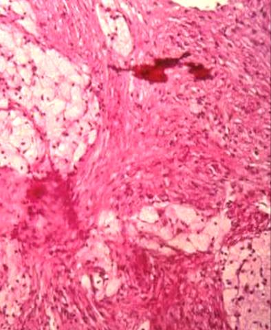 Histiocytoma (Benign Fibrous Histiocytoma) - Pathology - Orthobullets