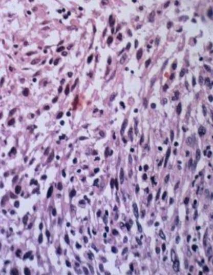 Pleomorphic Sarcoma of Bone (Malignant Fibrous Histiocytoma ...