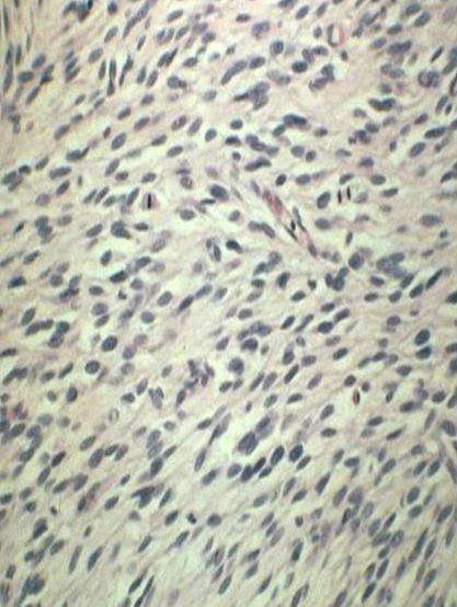 Fibrosarcoma of Bone - Pathology - Orthobullets