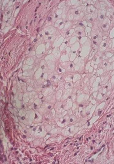 Chordoma - Pathology - Orthobullets
