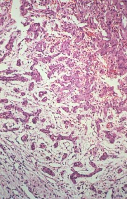 Hemangioendothelioma (hemangiosarcoma) - Pathology - Orthobullets