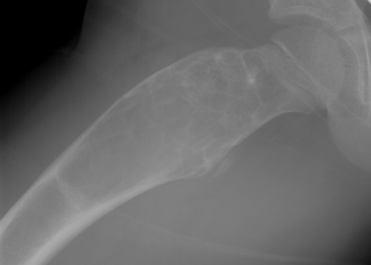 Aneurysmal Bone Cyst - Pathology - Orthobullets