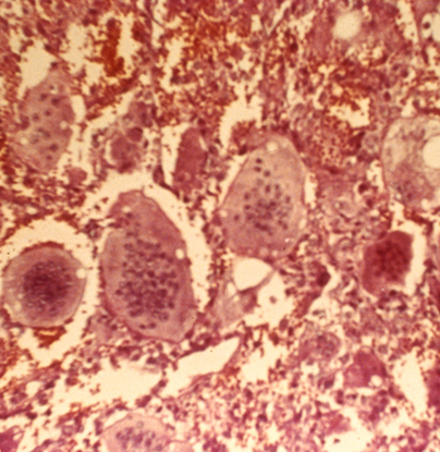 Aneurysmal Bone Cyst - Pathology - Orthobullets