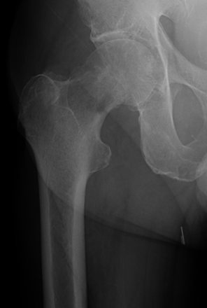 Metastatic Disease of Extremity - Pathology - Orthobullets