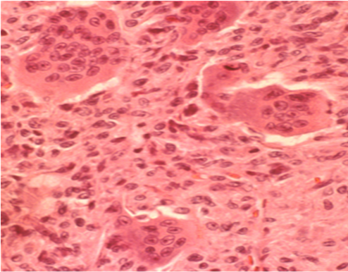 Giant Cell Tumor - Pathology - Orthobullets