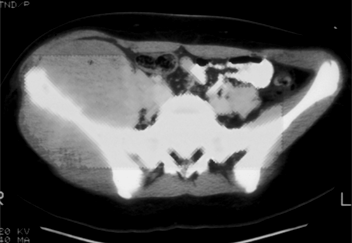 Ewing's Sarcoma - Pathology - Orthobullets